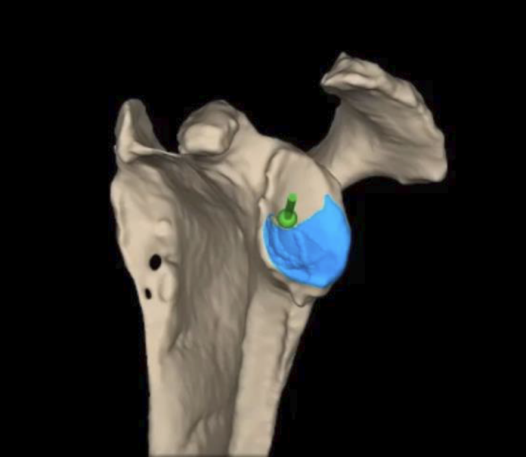 Surgery - Robotic Shoulder Doc