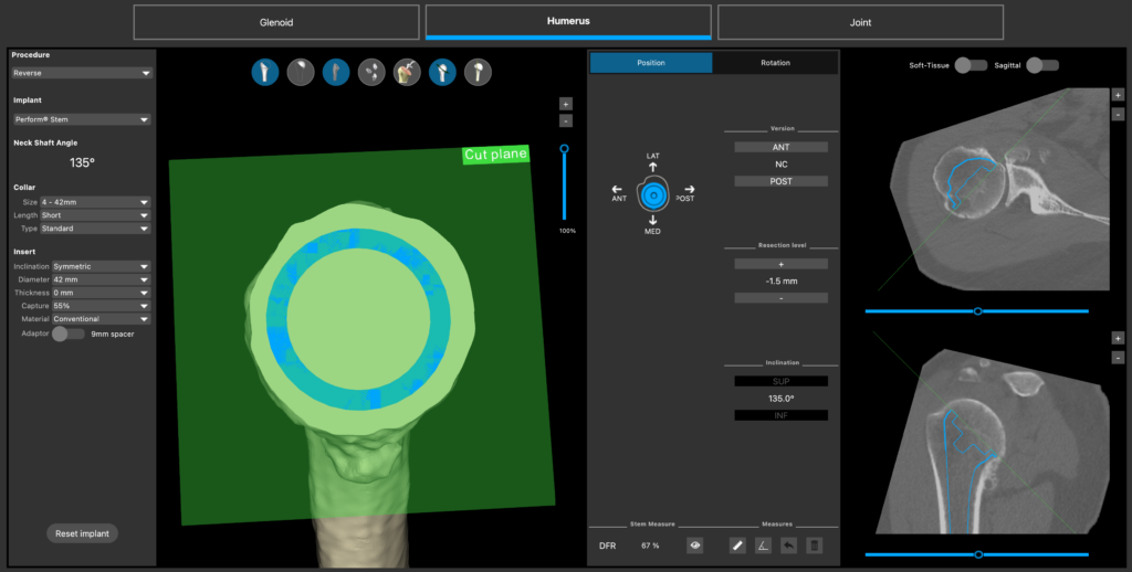 Surgery - Robotic Shoulder Doc
